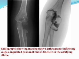 Proximal Radius Fractures in Children.pptx