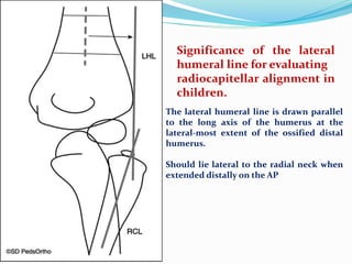 Proximal Radius Fractures in Children.pptx