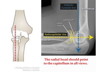 Proximal Radius Fractures in Children.pptx