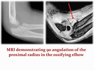Proximal Radius Fractures in Children.pptx
