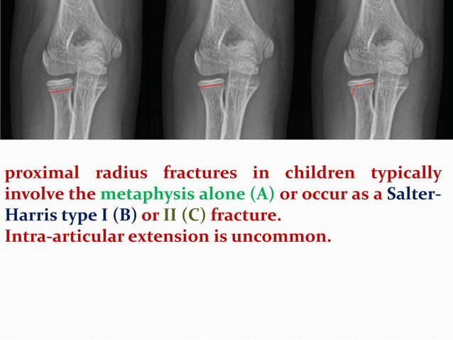 Proximal Radius Fractures in Children.pptx | Death, Injury, or Military ...