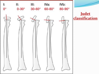 Proximal Radius Fractures in Children.pptx