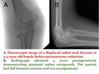 Proximal Radius Fractures in Children.pptx