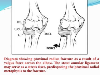 Proximal Radius Fractures in Children.pptx