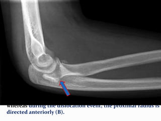 Proximal Radius Fractures in Children.pptx