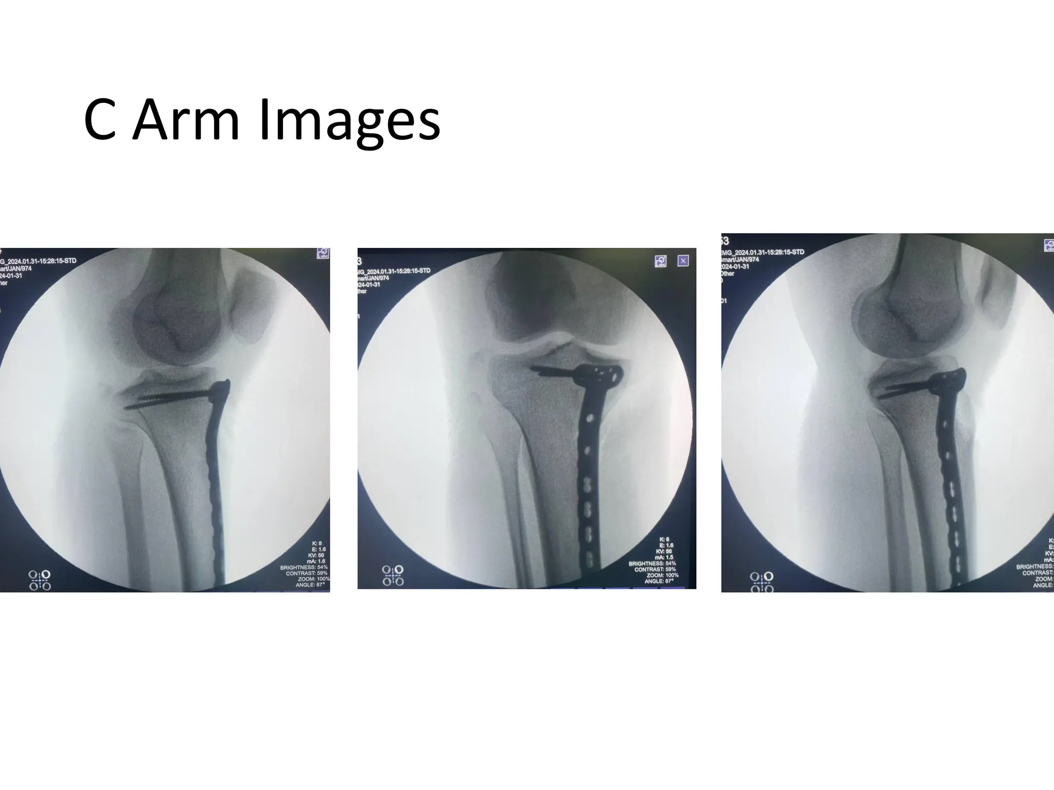 Proximal tibia - fibula fracture.pdf