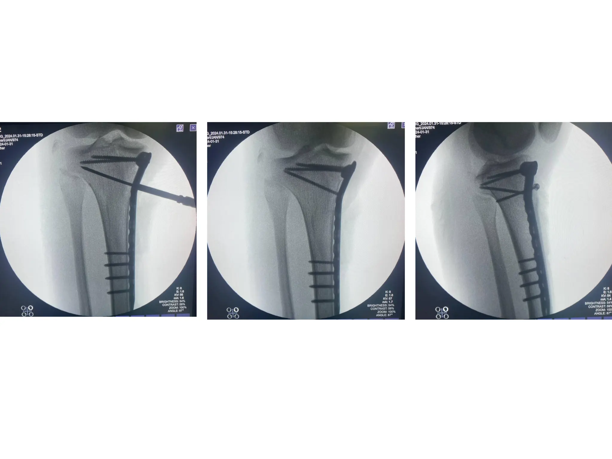 Proximal tibia - fibula fracture.pdf