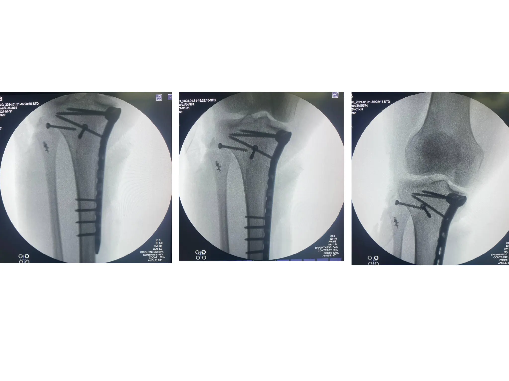 Proximal tibia - fibula fracture.pdf