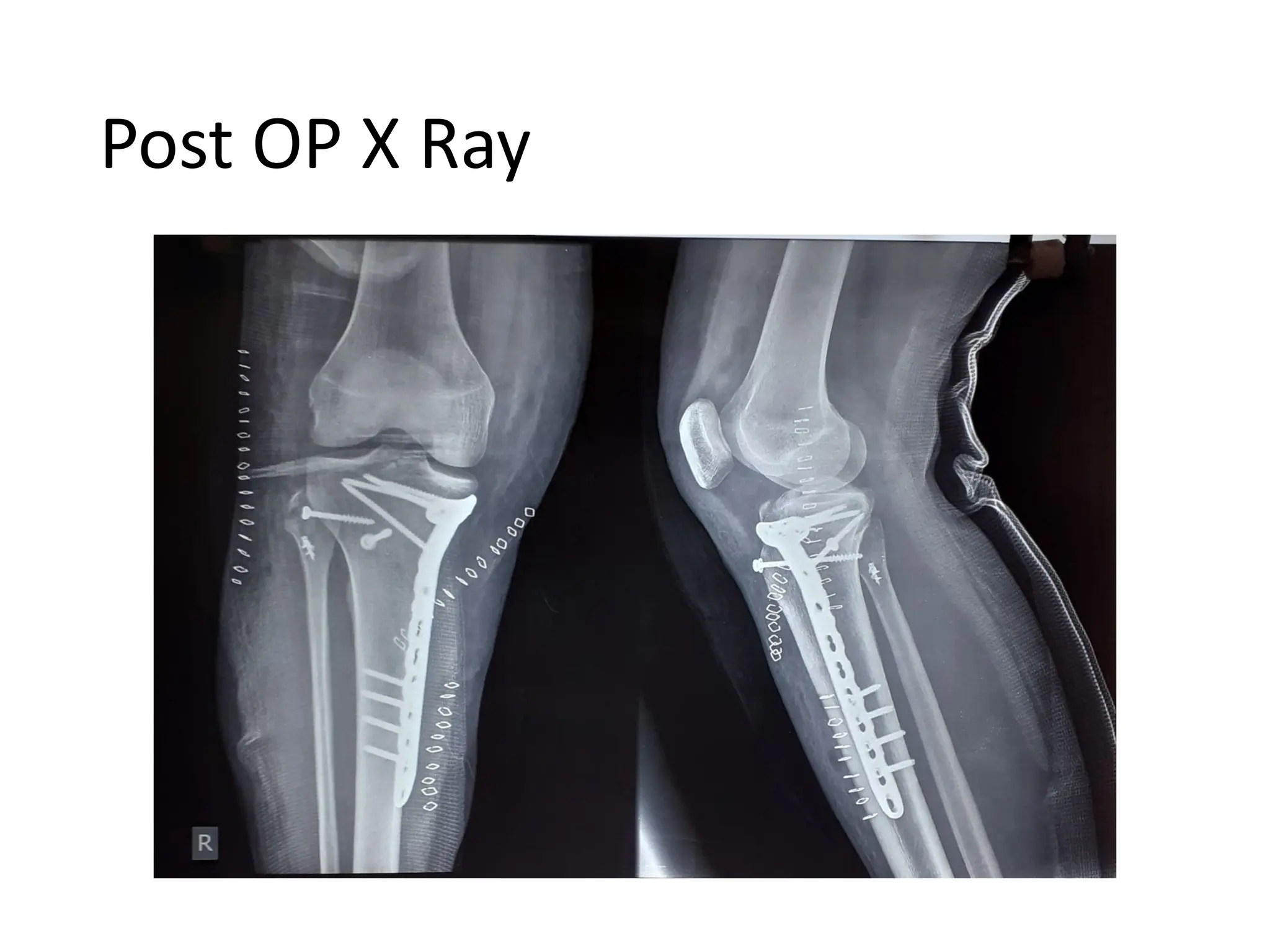 Proximal tibia - fibula fracture.pdf