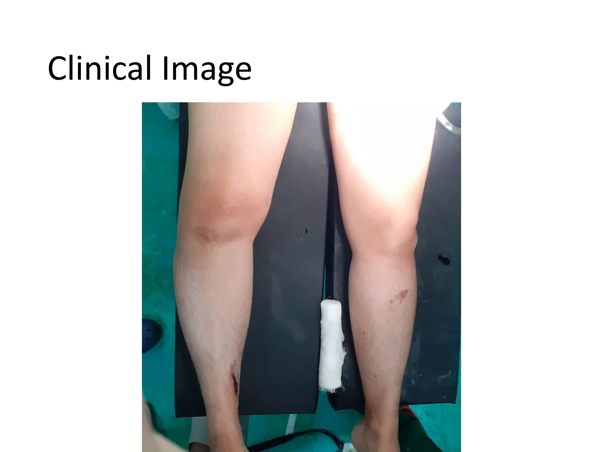 Proximal tibia - fibula fracture.pdf