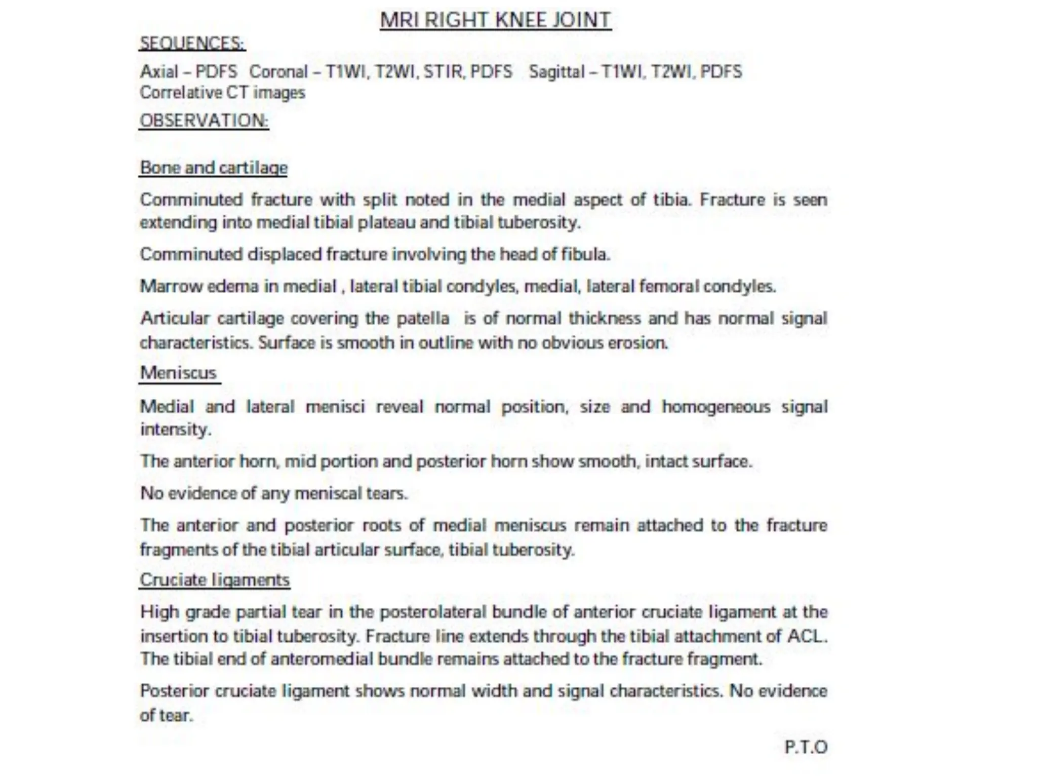 Proximal tibia - fibula fracture.pdf