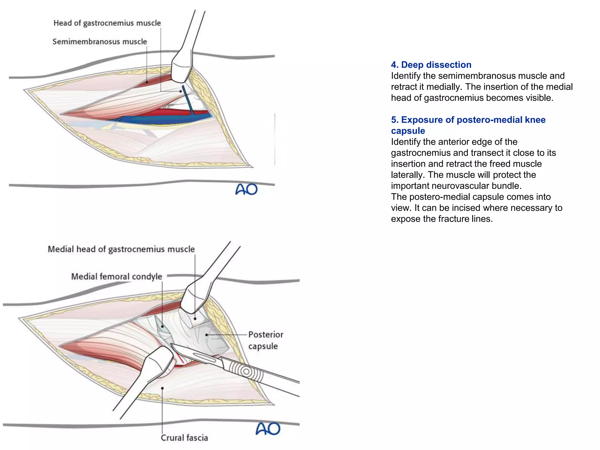 proximal tibia approach.pptx