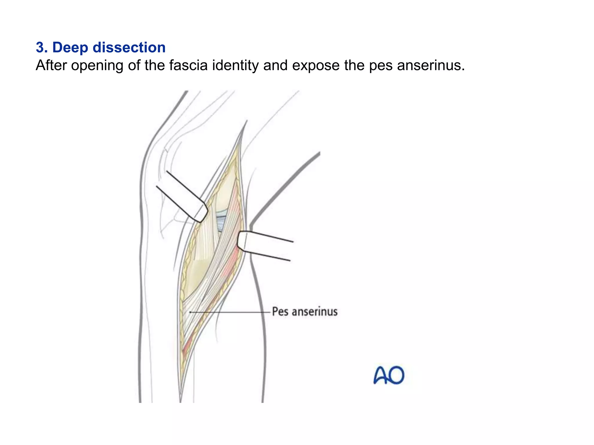 proximal tibia approach.pptx
