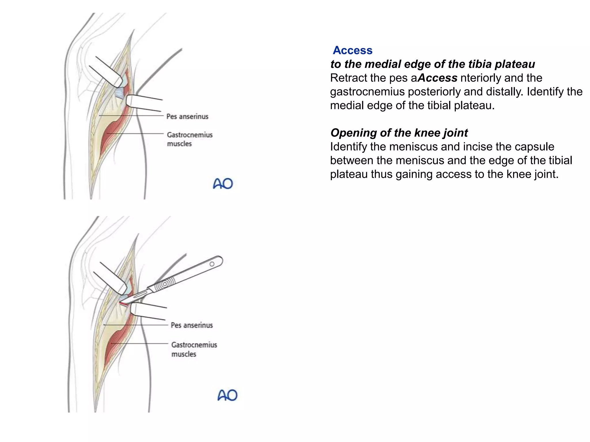 proximal tibia approach.pptx
