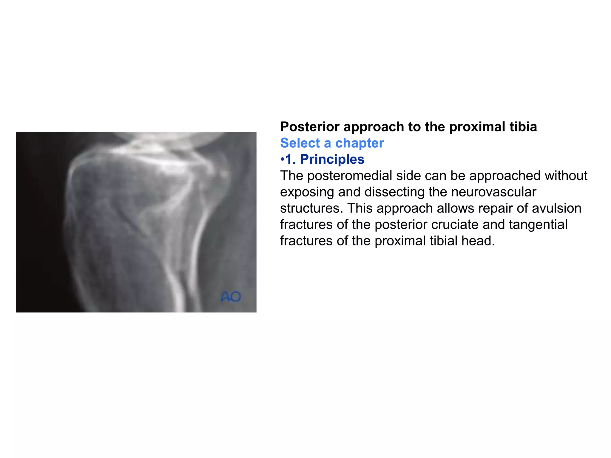 proximal tibia approach.pptx
