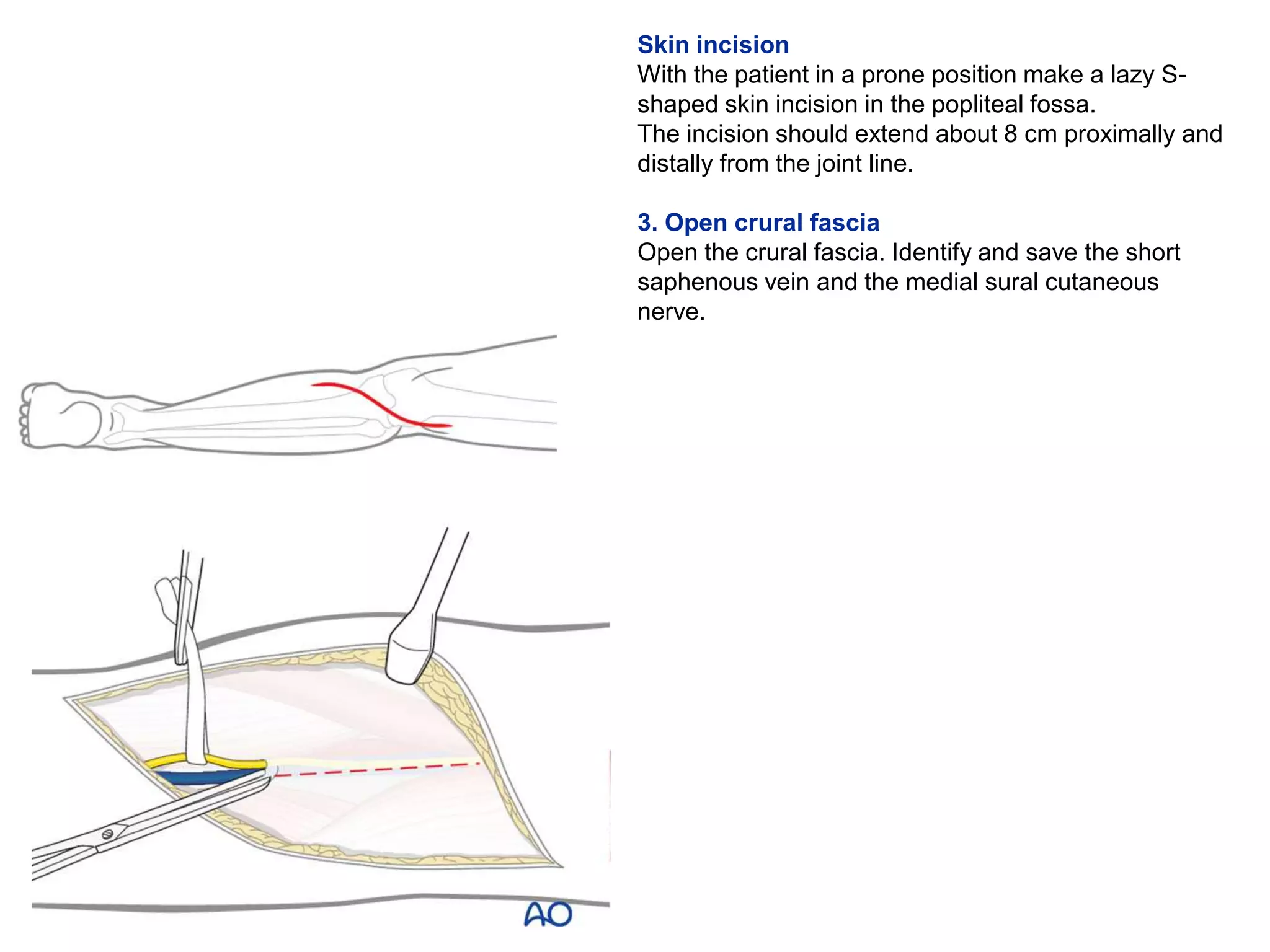 proximal tibia approach.pptx