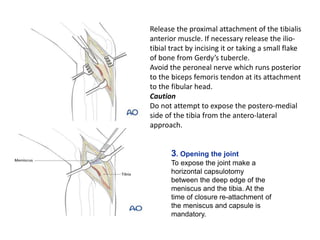 proximal tibia approach.pptx