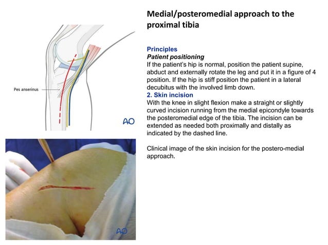 proximal tibia approach.pptx
