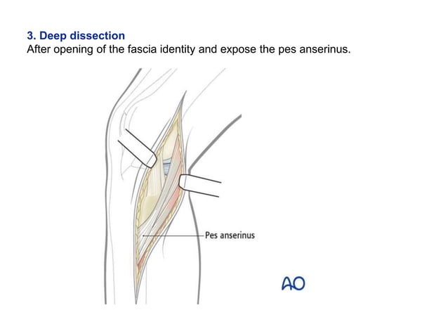 proximal tibia approach.pptx