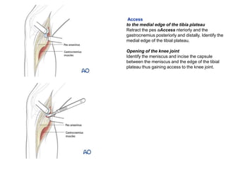 proximal tibia approach.pptx