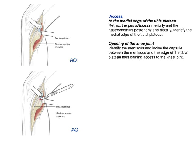proximal tibia approach.pptx