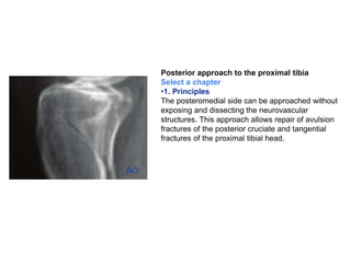 proximal tibia approach.pptx