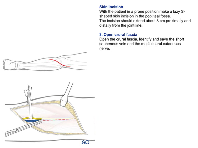 proximal tibia approach.pptx