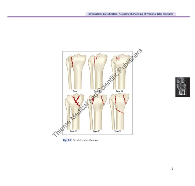 Guidelines in Fracture Management - Proximal Tibia by Babhulkar | PPT