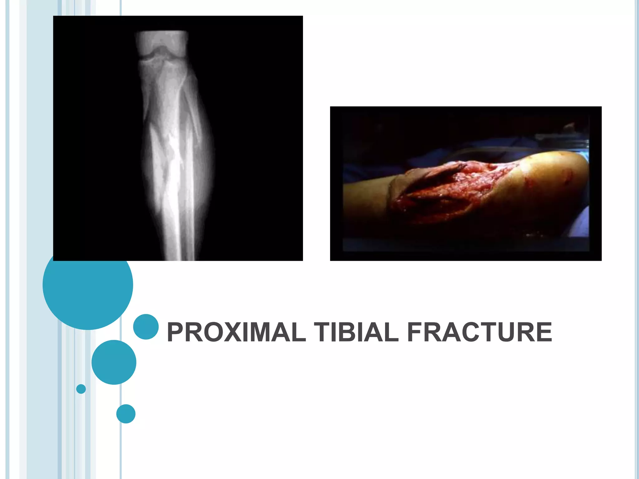 Proximal tibia fracture | PPTX