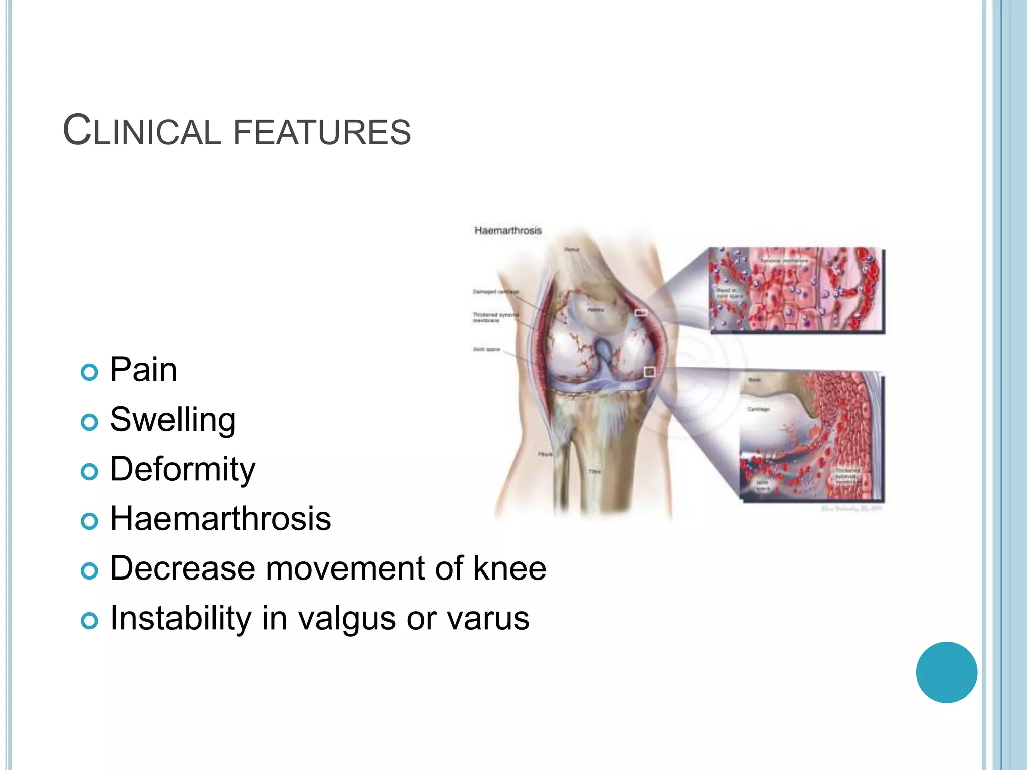 Proximal tibia fracture | PPTX