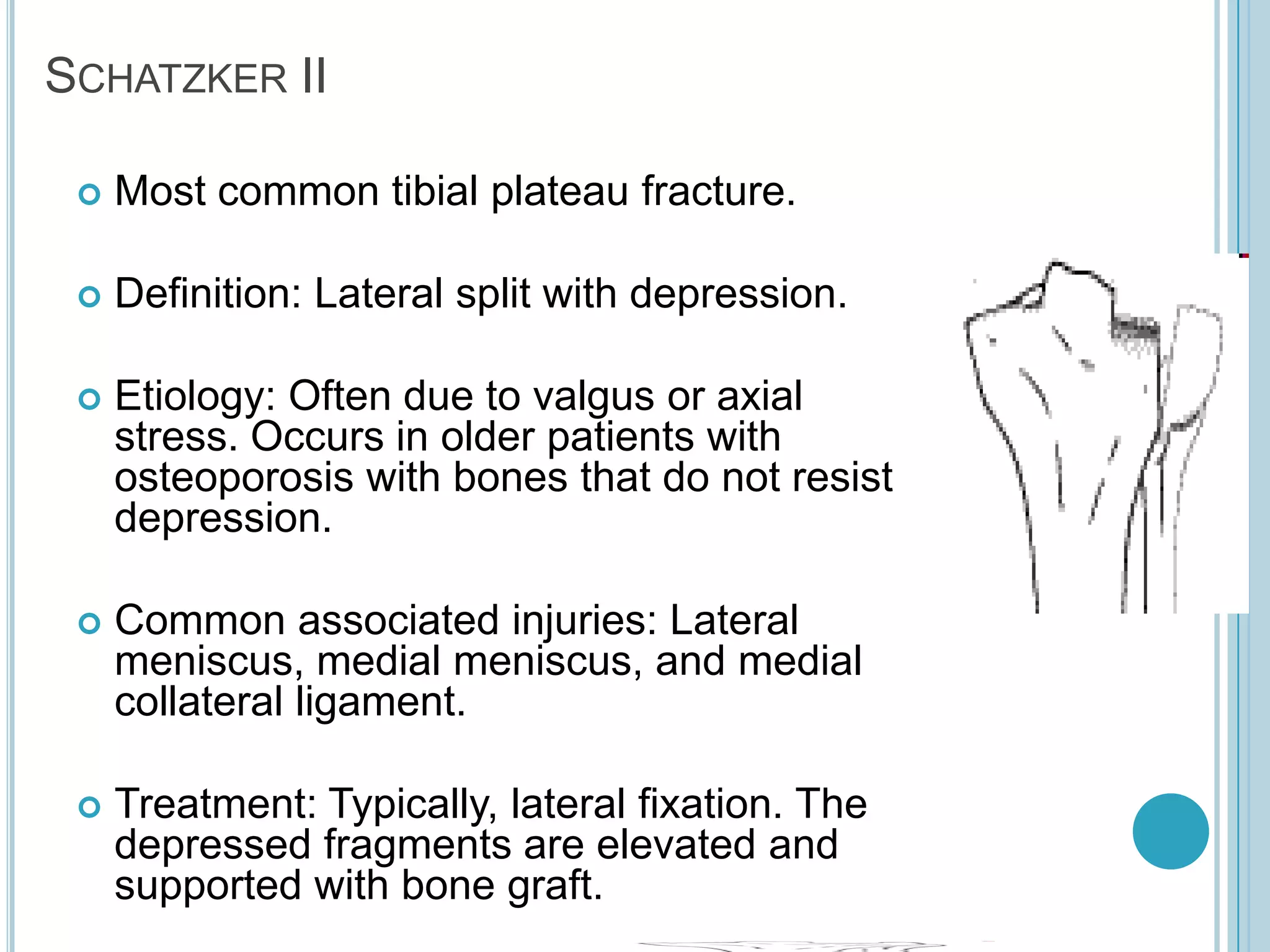 Proximal tibia fracture | PPTX