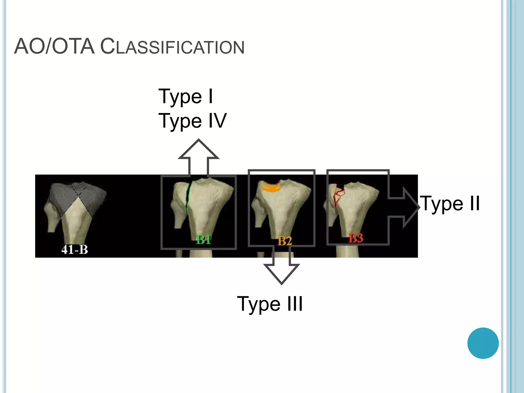 Proximal tibia fracture | PPTX