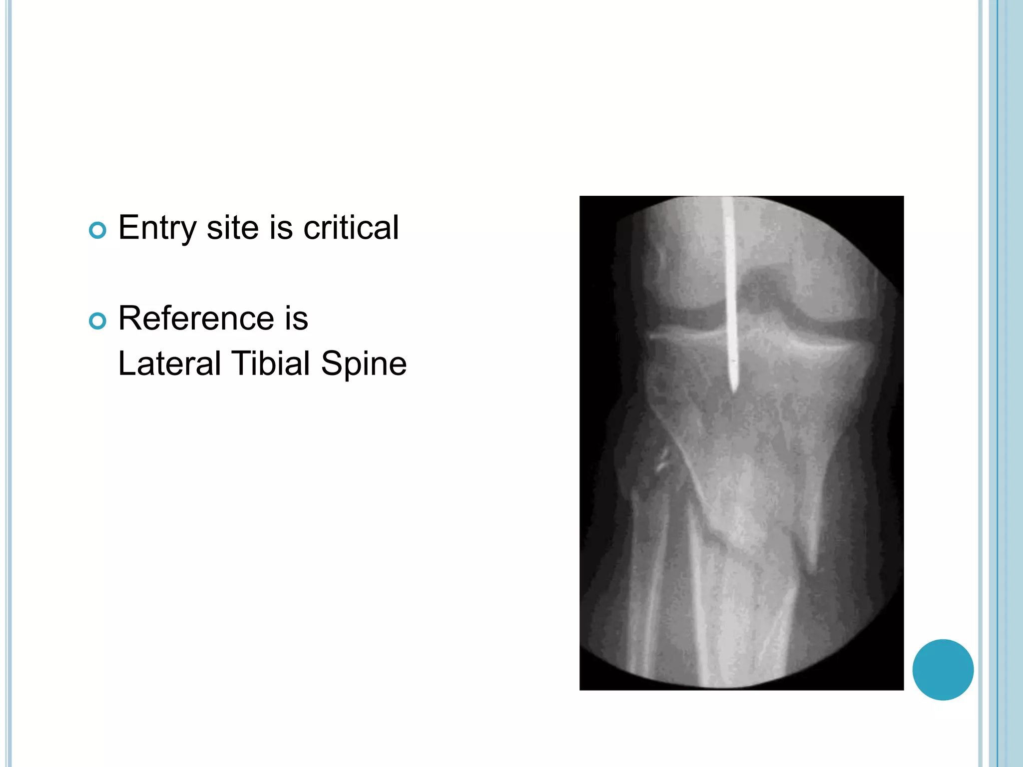 Proximal tibia fracture | PPTX