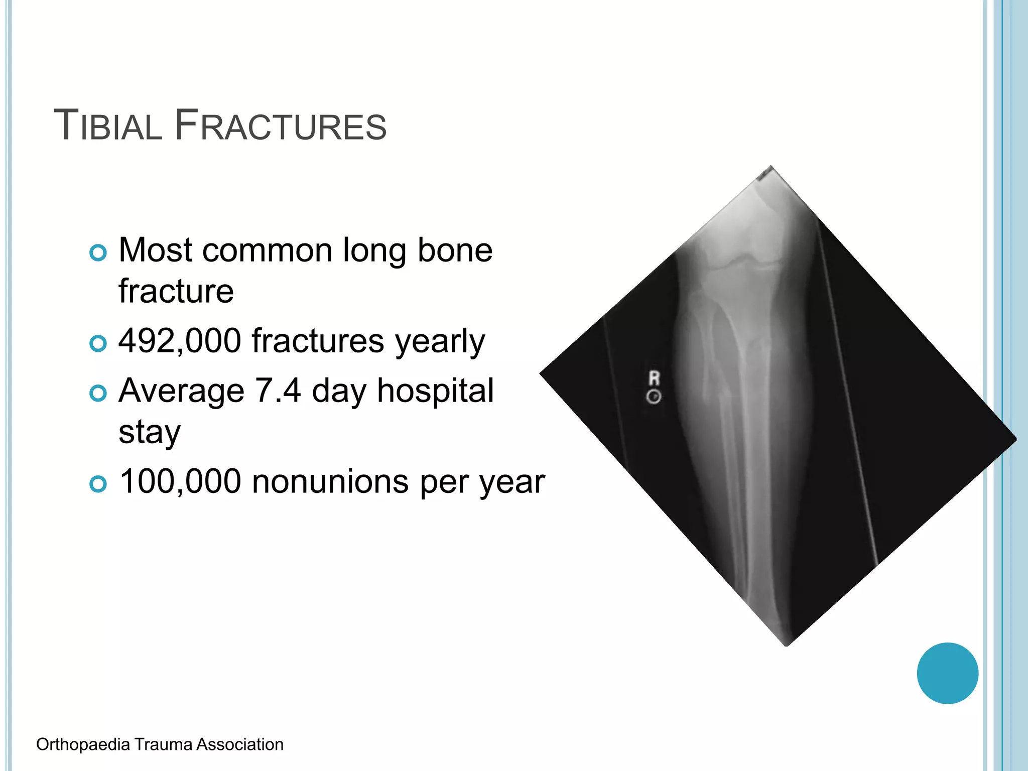 Proximal tibia fracture | PPTX
