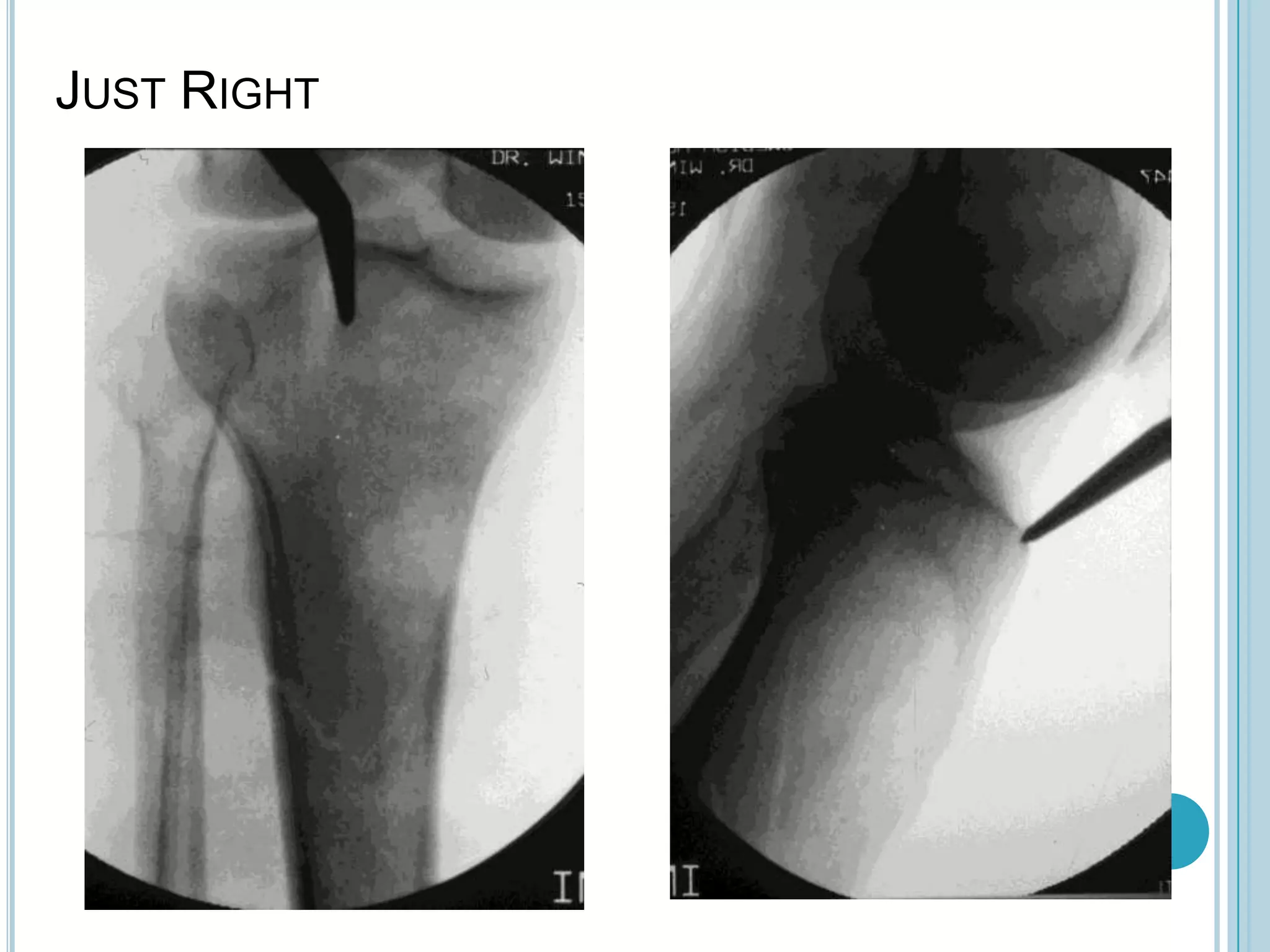 Proximal tibia fracture | PPTX