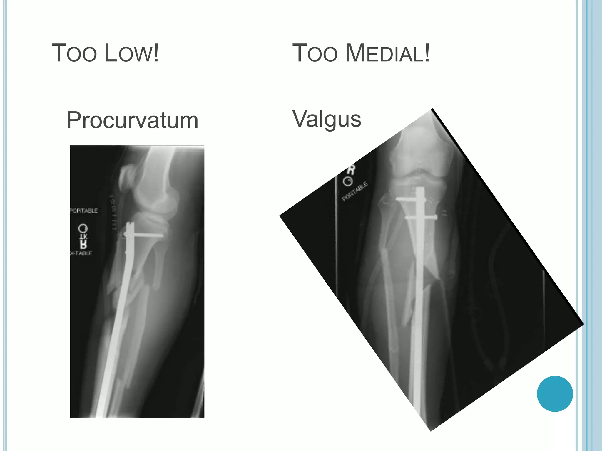 Proximal tibia fracture | PPTX