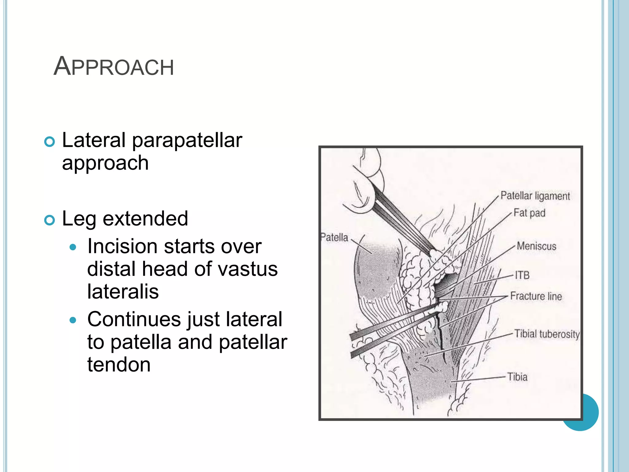 Proximal tibia fracture | PPTX