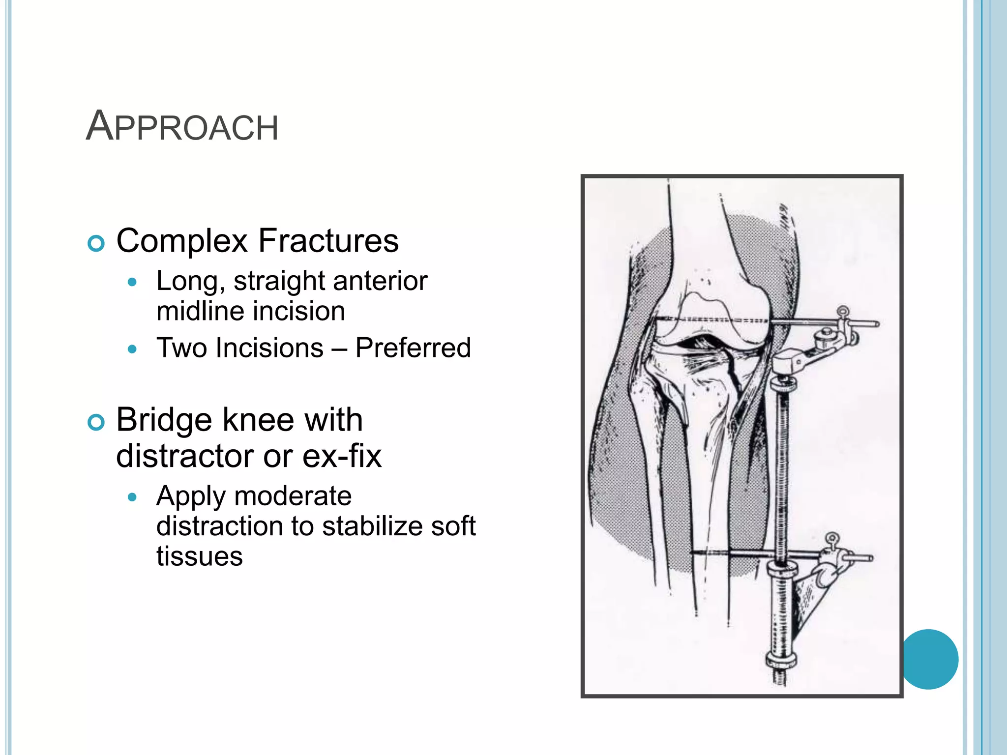 Proximal tibia fracture | PPTX