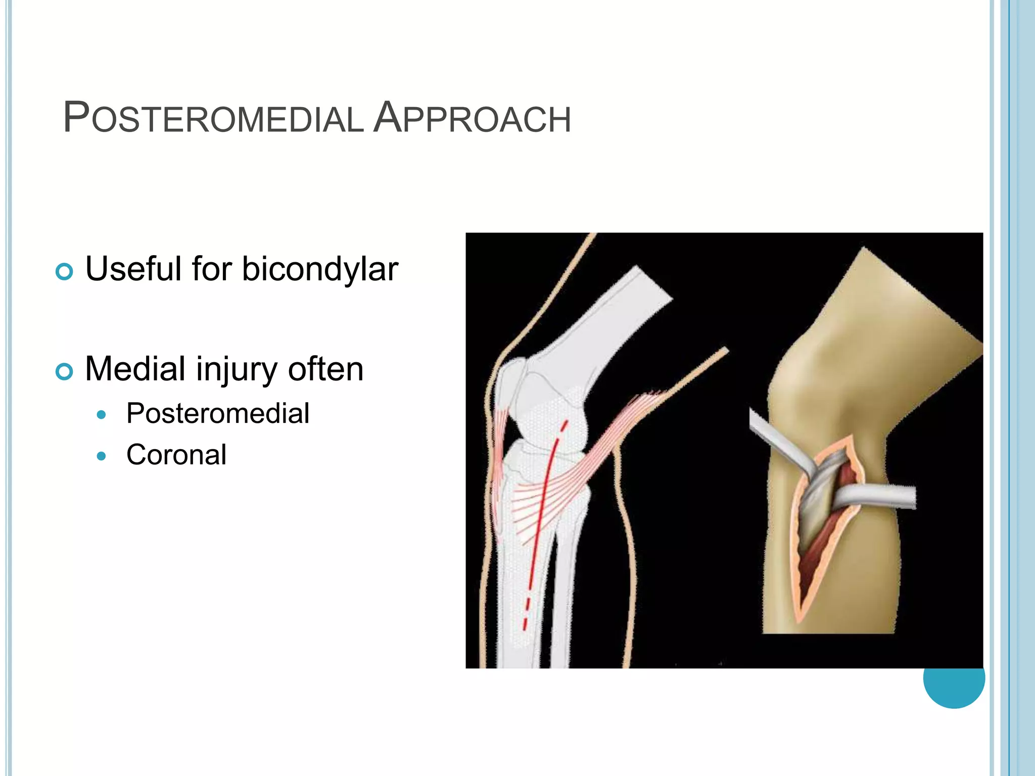 Proximal tibia fracture | PPTX