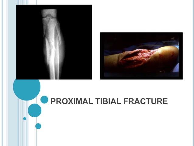Proximal tibia fracture | PPTX