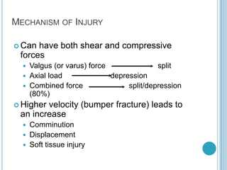 Proximal tibia fracture | PPTX