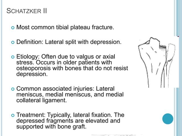 Proximal tibia fracture | PPTX