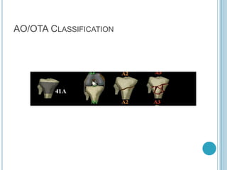 Proximal tibia fracture | PPTX