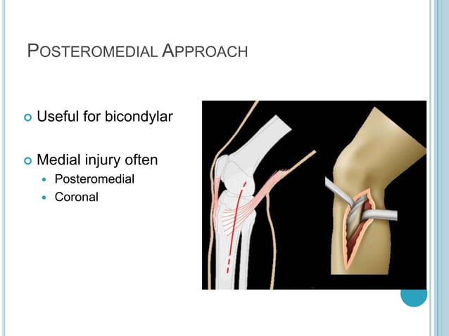 Proximal tibia fracture | PPTX