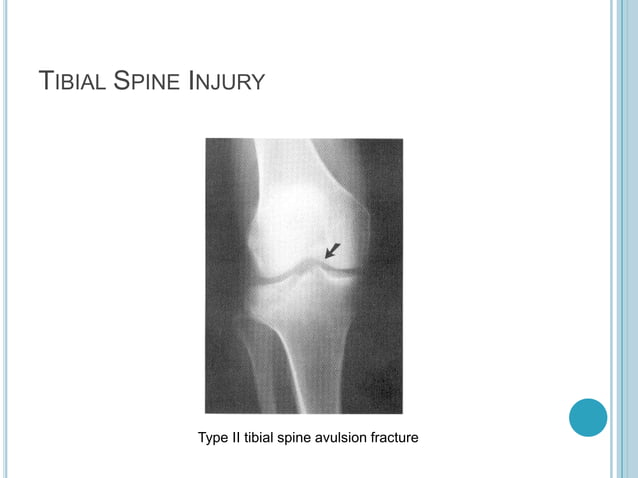 Proximal tibia fracture | PPTX