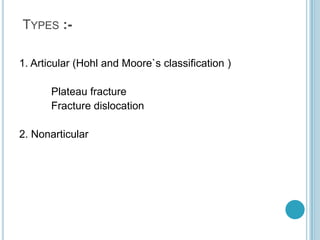 Proximal tibia fracture | PPTX