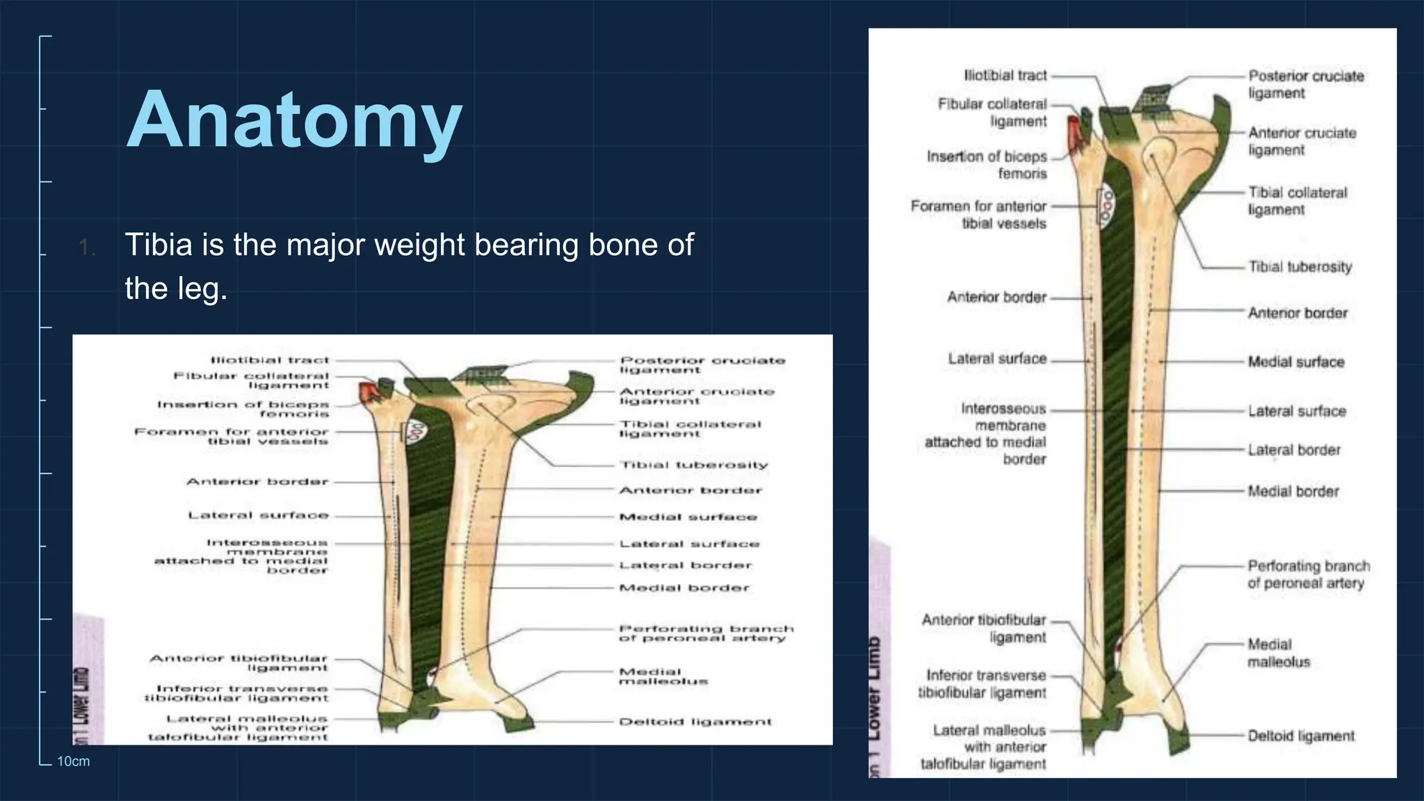 proximal tibia fracture and mechanism with etiology | PPTX