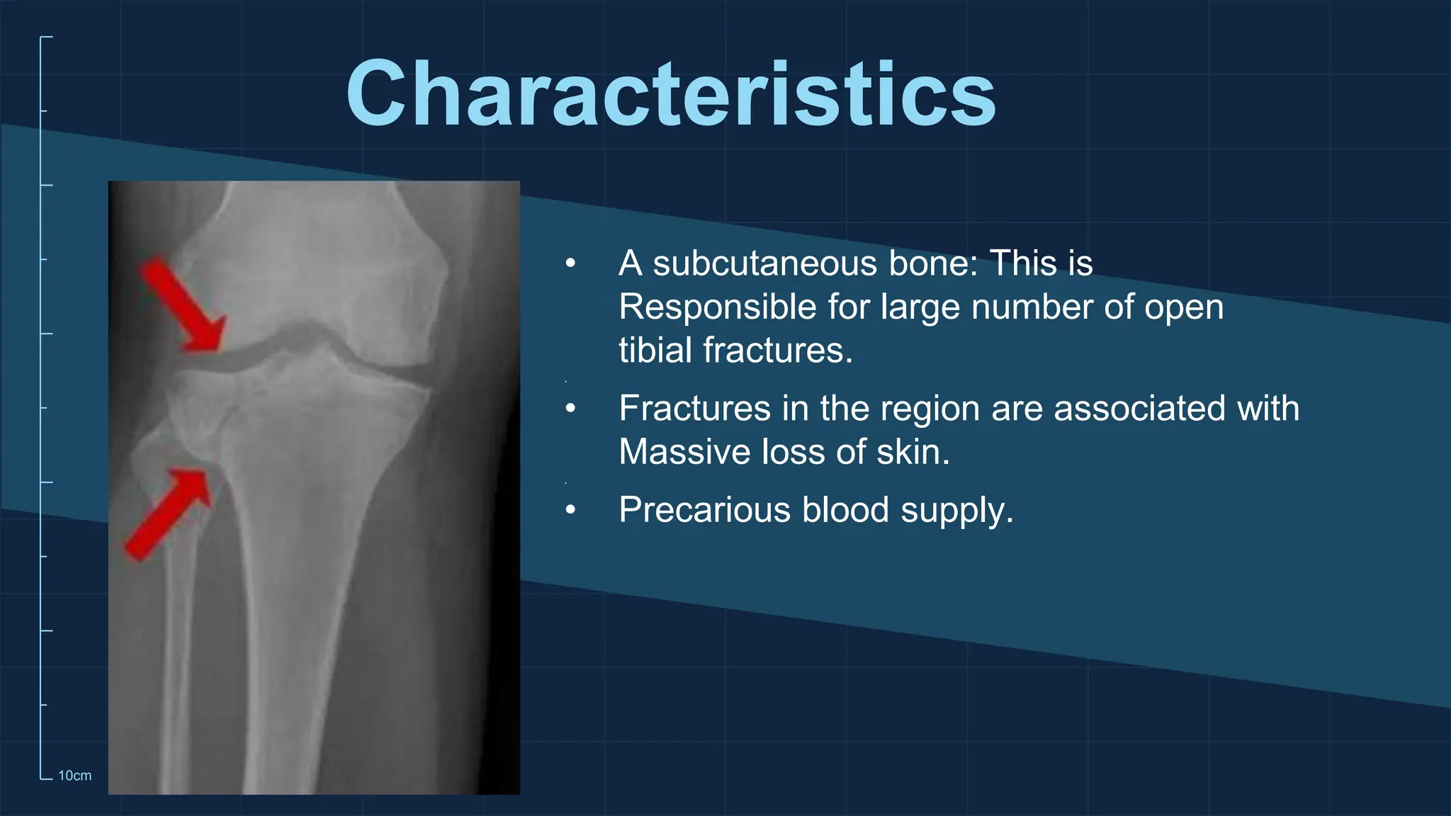 proximal tibia fracture and mechanism with etiology | PPTX