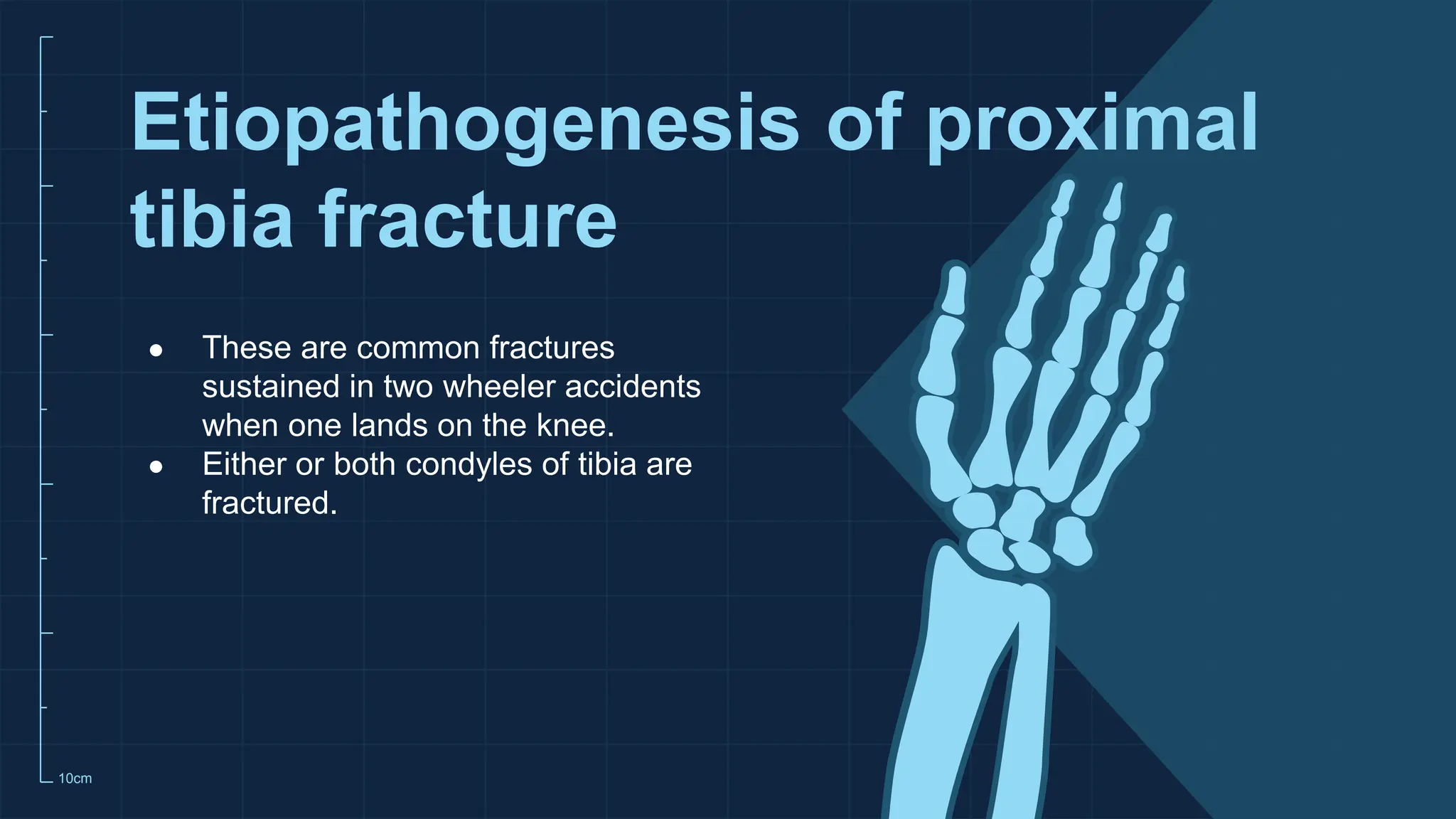 proximal tibia fracture and mechanism with etiology | PPTX