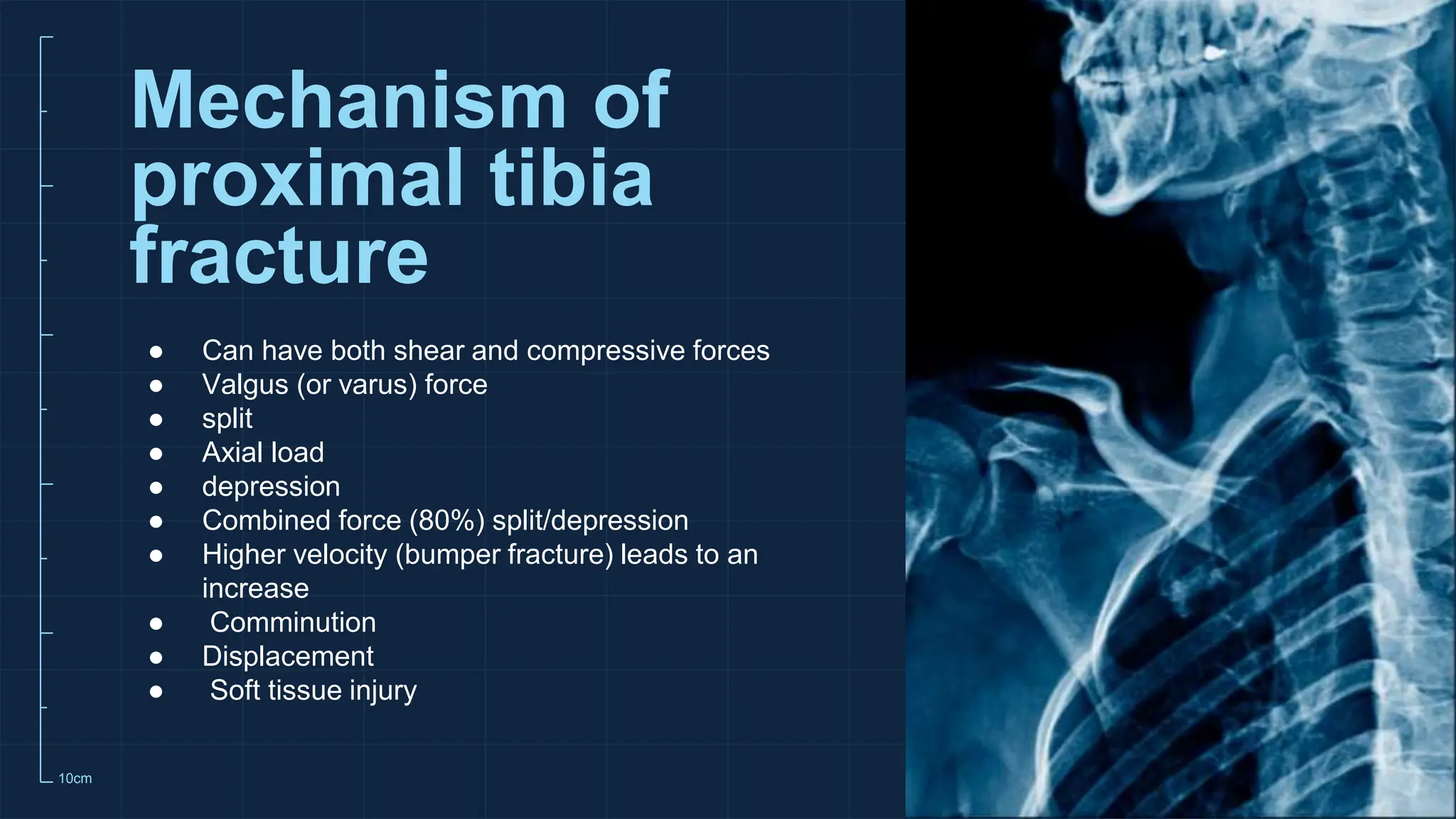 proximal tibia fracture and mechanism with etiology | PPTX